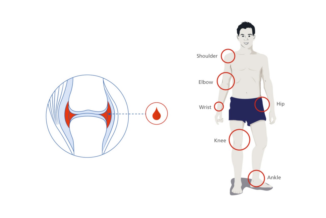 Understanding Haemophilia